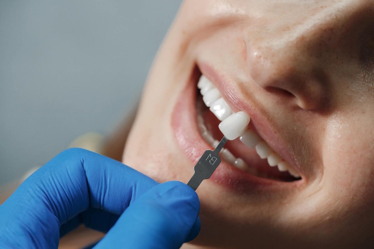 Porcelain Veneers - Passion Family Dental North Lakes